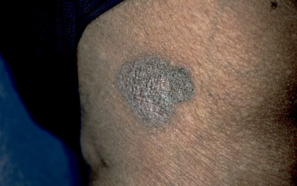 The Skin of Color Revolution in Dermatology: Crucial Lessons Learned ...